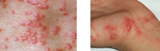 Scabies - Jupiter Dermatology & Hair Restoration