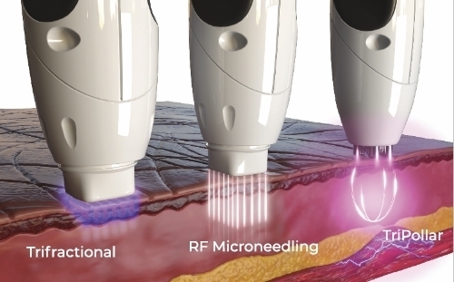 Pyramid Facelift - Jupiter Dermatology & Hair Restoration