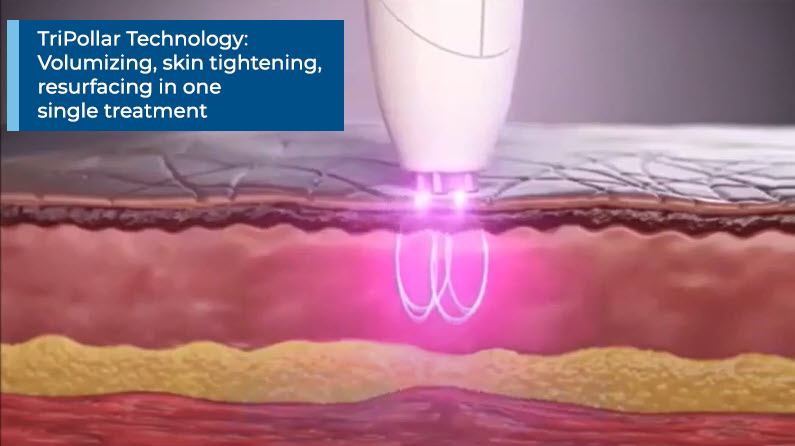 M2 - VoluDerm & TriPollar - Jupiter Dermatology & Hair Restoration