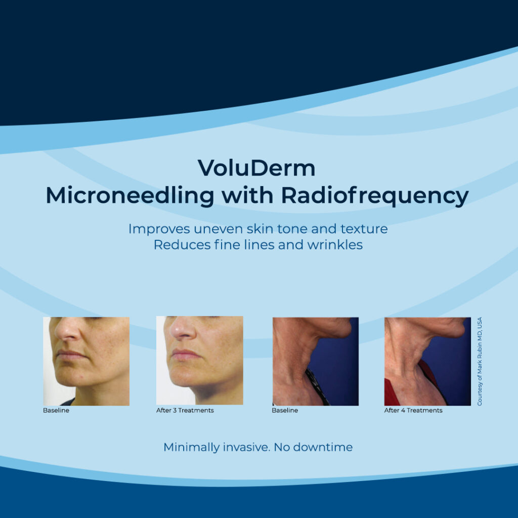 Microneedling with Radiofrequency - Jupiter Dermatology & Hair Restoration